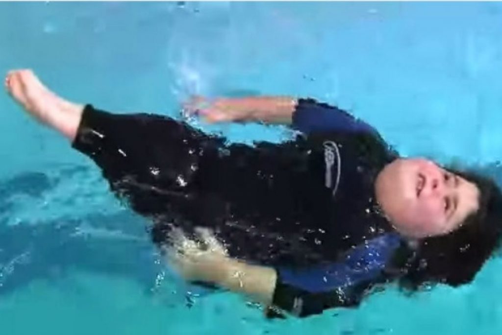 La bambina sirena, la storia di Shiloh Pepin e della sua sirenomelia